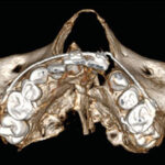 cleft-table-2 - Decisions in Dentistry
