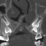 cleft-table-2 - Decisions in Dentistry