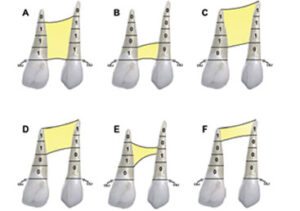 Cone Beam Imaging In Orofacial Cleft Therapy - Decisions in Dentistry