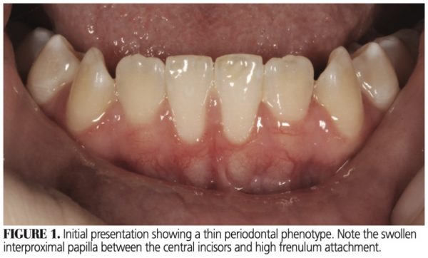 Healing Progression of the Free Gingival Graft - Decisions in Dentistry