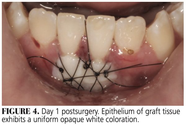 Healing Progression of the Free Gingival Graft - Decisions in Dentistry