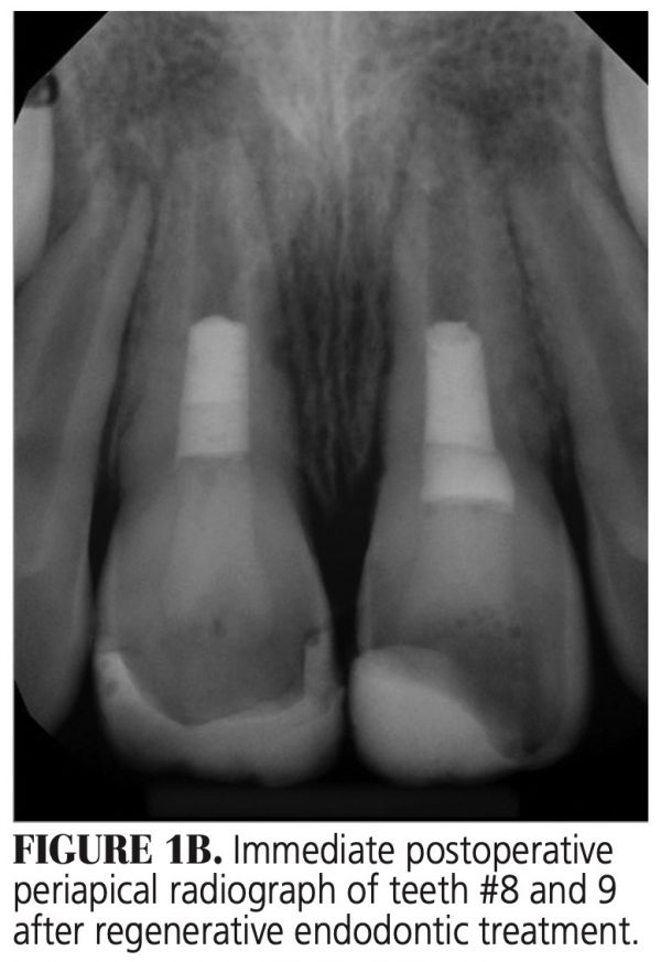 Introduction to Regenerative Endodontics - Decisions in Dentistry