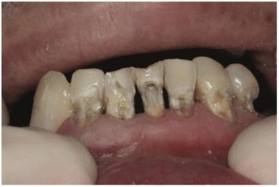 10-Year Follow-Up on Resin Modified Glass Ionomer Restorations ...