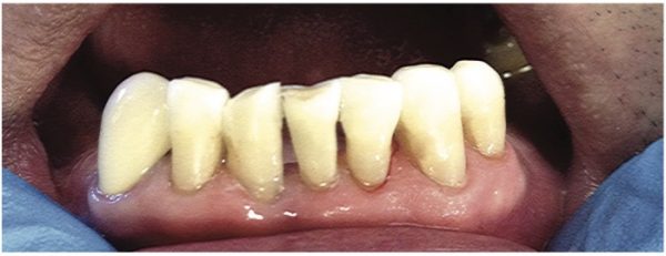 10-Year Follow-Up on Resin Modified Glass Ionomer Restorations ...
