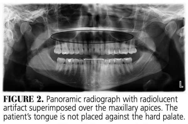 Optimal Panorex Imaging - Decisions in Dentistry