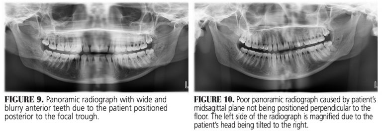 Optimal Panorex Imaging - Decisions in Dentistry