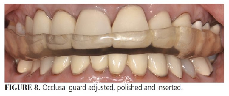Alternative Method for Occlusal Guard Fabrication - Decisions in Dentistry