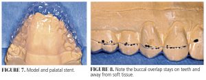 Maintaining Palatal Comfort Following Gingival Grafting - Decisions in ...