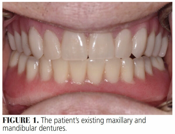 Simplified Denture Duplication for Implant Surgical Guides - Decisions ...