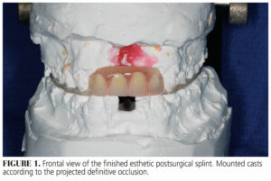 Easy Method for Esthetic Postsurgical Splint Fabrication - Decisions in ...