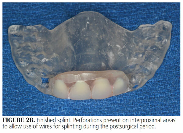 Easy Method for Esthetic Postsurgical Splint Fabrication - Decisions in ...