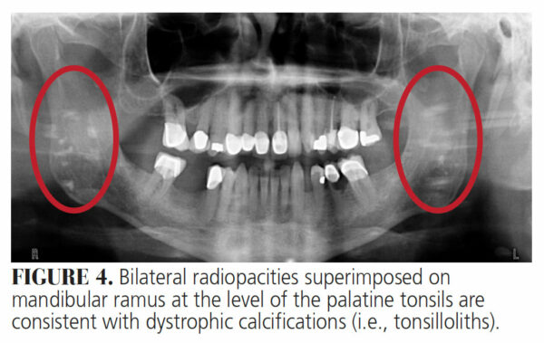 Diagnosing Incidental Thyroid Calcifications on Dental Images ...