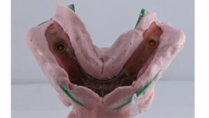 Importance of Records and Occlusion in Advanced Implant Prosthodontics ...