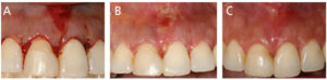 Concepts and Considerations for Surgical Crown Lengthening - Decisions ...