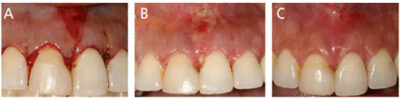 Concepts and Considerations for Surgical Crown Lengthening - Decisions ...