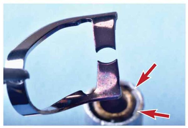 Rubber Dam Isolation Techniques for Complex Restorations - Decisions in ...
