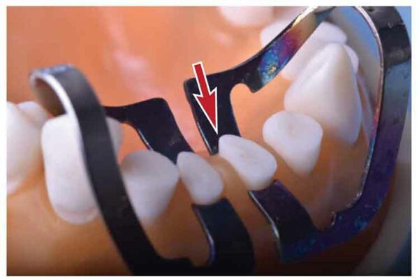 Rubber Dam Isolation Techniques for Complex Restorations - Decisions in ...