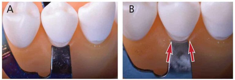 Rubber Dam Isolation Techniques for Complex Restorations - Decisions in ...