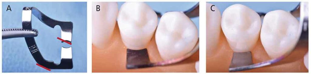 Rubber Dam Isolation Techniques for Complex Restorations - Decisions in ...