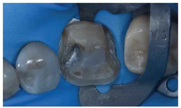 Rubber Dam Isolation Techniques for Complex Restorations - Decisions in ...