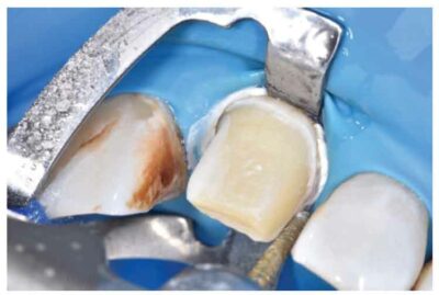 Rubber Dam Isolation Techniques for Complex Restorations - Decisions in ...