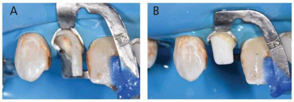 Rubber Dam Isolation Techniques for Complex Restorations - Decisions in ...