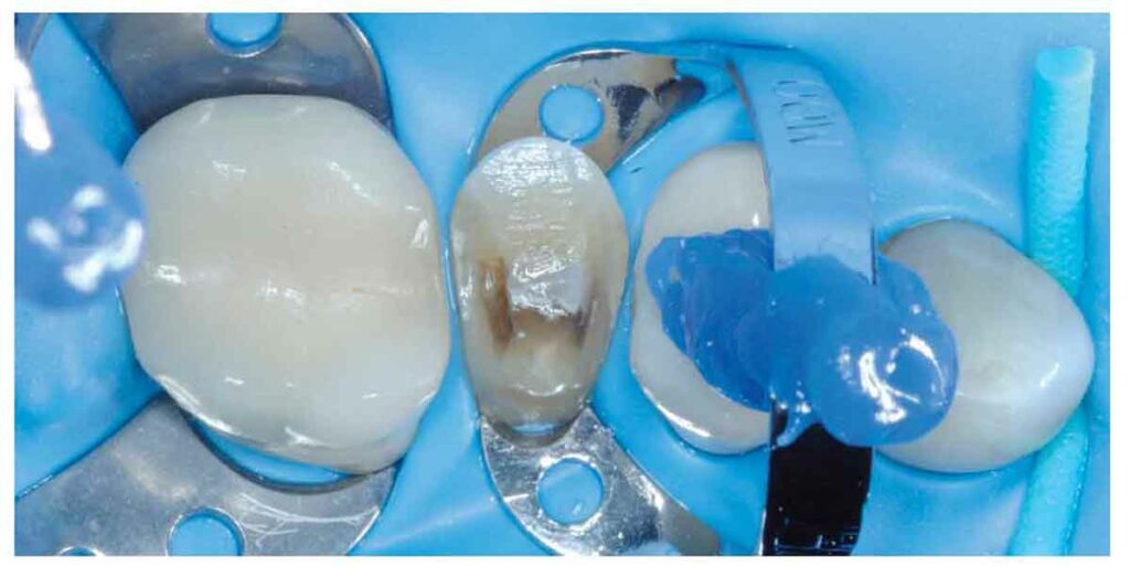 Rubber Dam Isolation Techniques for Complex Restorations - Decisions in ... Rubber Dam Isolation Techniques for Complex Restorations - Decisions in ...