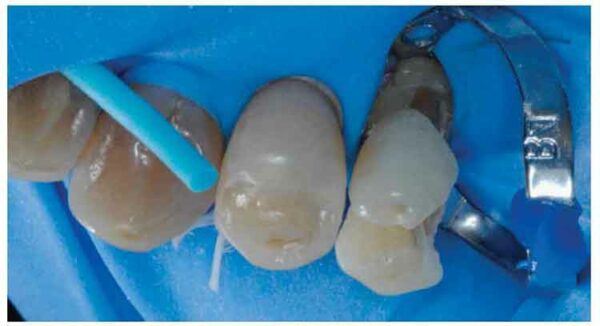 Rubber Dam Isolation Techniques for Complex Restorations - Decisions in ...