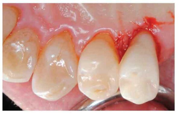 Rubber Dam Isolation Techniques for Complex Restorations - Decisions in ...