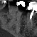 0321-cvek-pulpotomy - Decisions in Dentistry