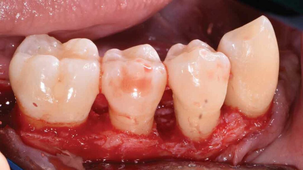 Periodontal Medicine: From Teeth To Total Body Health - Decisions in ...