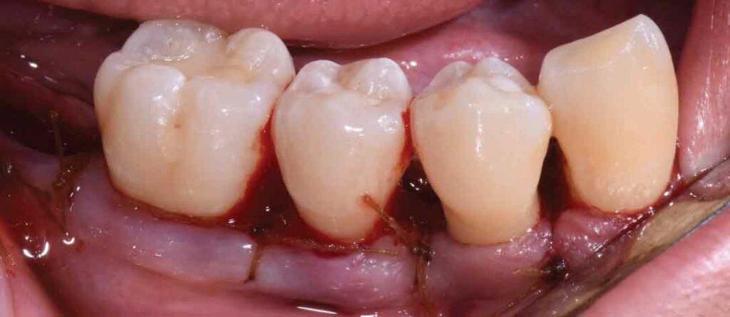 Periodontal Medicine: From Teeth To Total Body Health - Decisions in ...