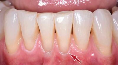 Decision-Making In Modern Mucogingival Therapy - Decisions in Dentistry