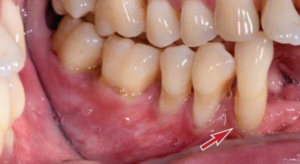 Decision-Making In Modern Mucogingival Therapy - Decisions in Dentistry