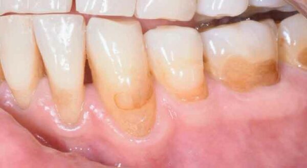 Decision-Making In Modern Mucogingival Therapy - Decisions in Dentistry