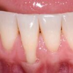 0521-did-mucogingival-therapy-fig-1 - Decisions in Dentistry