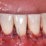 0521-did-mucogingival-therapy-fig-1 - Decisions in Dentistry