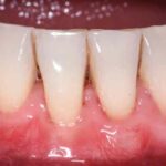 0521-did-mucogingival-therapy-fig-1 - Decisions in Dentistry