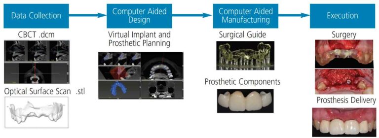 Utilizing a Digital Workflow for Implant Treatment Planning - Decisions ...