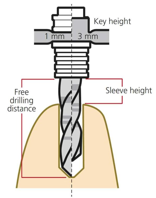 Utilizing a Digital Workflow for Implant Treatment Planning - Decisions ...