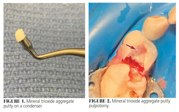 Novel Medicaments for Pulpotomies in Primary Teeth - Decisions in Dentistry