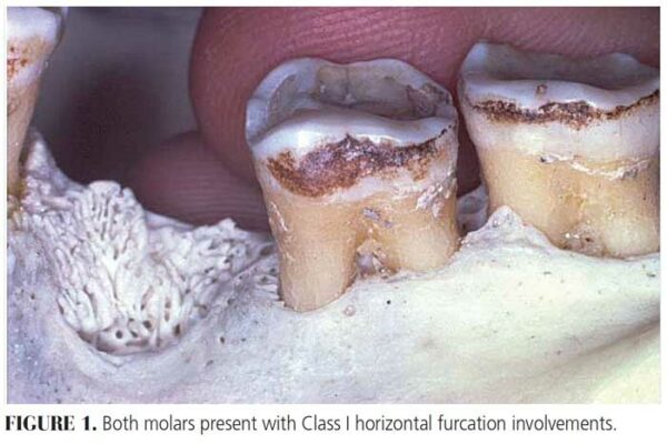 Treatment Approaches to Periodontally Furcated Mandibular Molars ...
