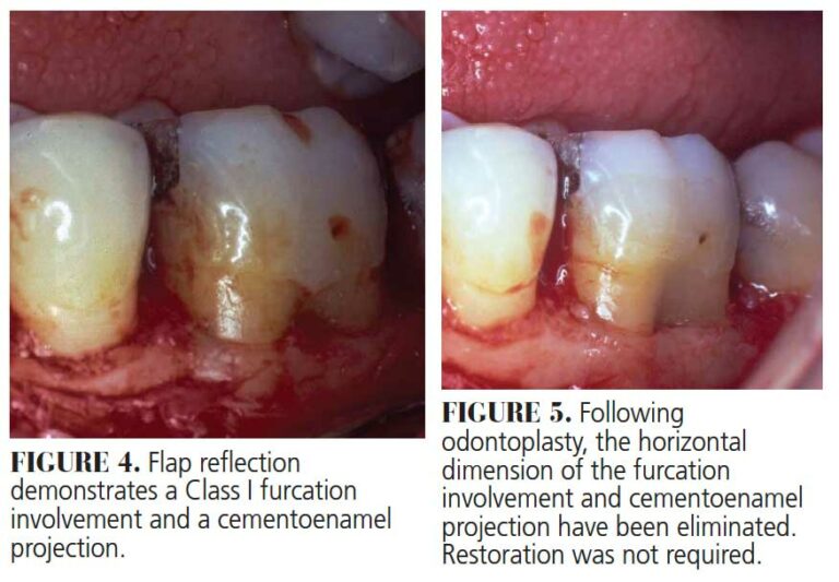Treatment Approaches to Periodontally Furcated Mandibular Molars ...