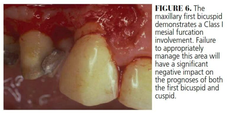 Treatment Approaches to Periodontally Furcated Mandibular Molars ...