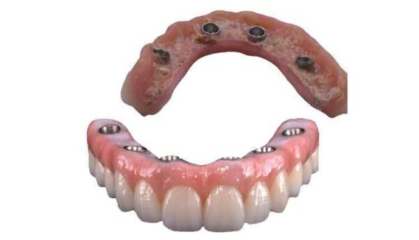 Maintaining Implant Supported Hybrid Prostheses - Decisions in Dentistry