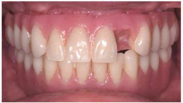 Maintaining Implant Supported Hybrid Prostheses - Decisions in Dentistry