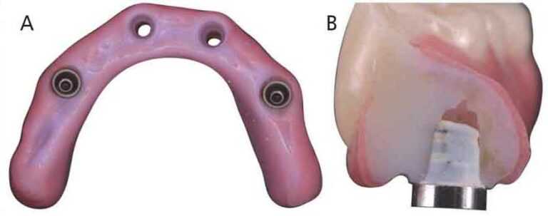Maintaining Implant Supported Hybrid Prostheses - Decisions in Dentistry
