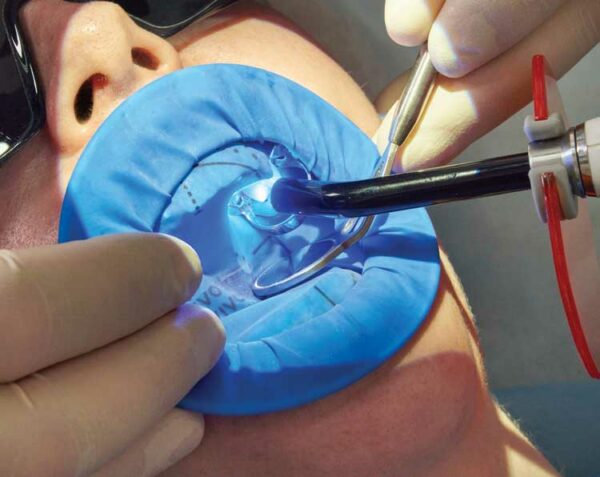 Advantages of Single-Shade Composites - Decisions in Dentistry