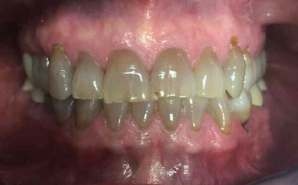 Esthetic Management of Tetracycline-Induced Staining - Decisions in ...