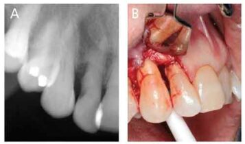 Scaling and Root Planing Remain Key to Successful Periodontal Therapy ...